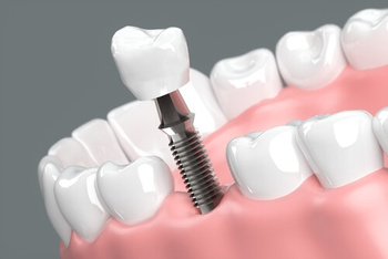 Dental Insurance That Covers Implants | Casey Dentists