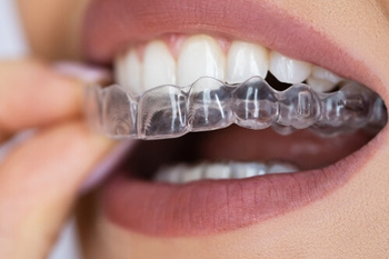 How Much Does Invisalign Cost? Key Elements to Consider